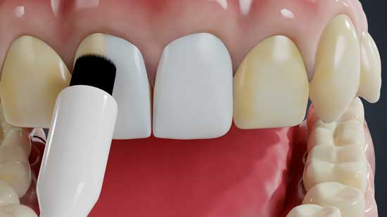 The Power of Professional Teeth Whitening - Dental Care of San Antonio